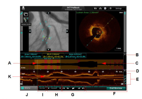 OCTAID How To Perform OCT - Cardiology Apps