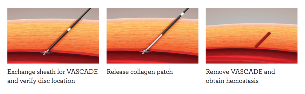 Basics - Vascular Closure Devices - Cardiology Apps