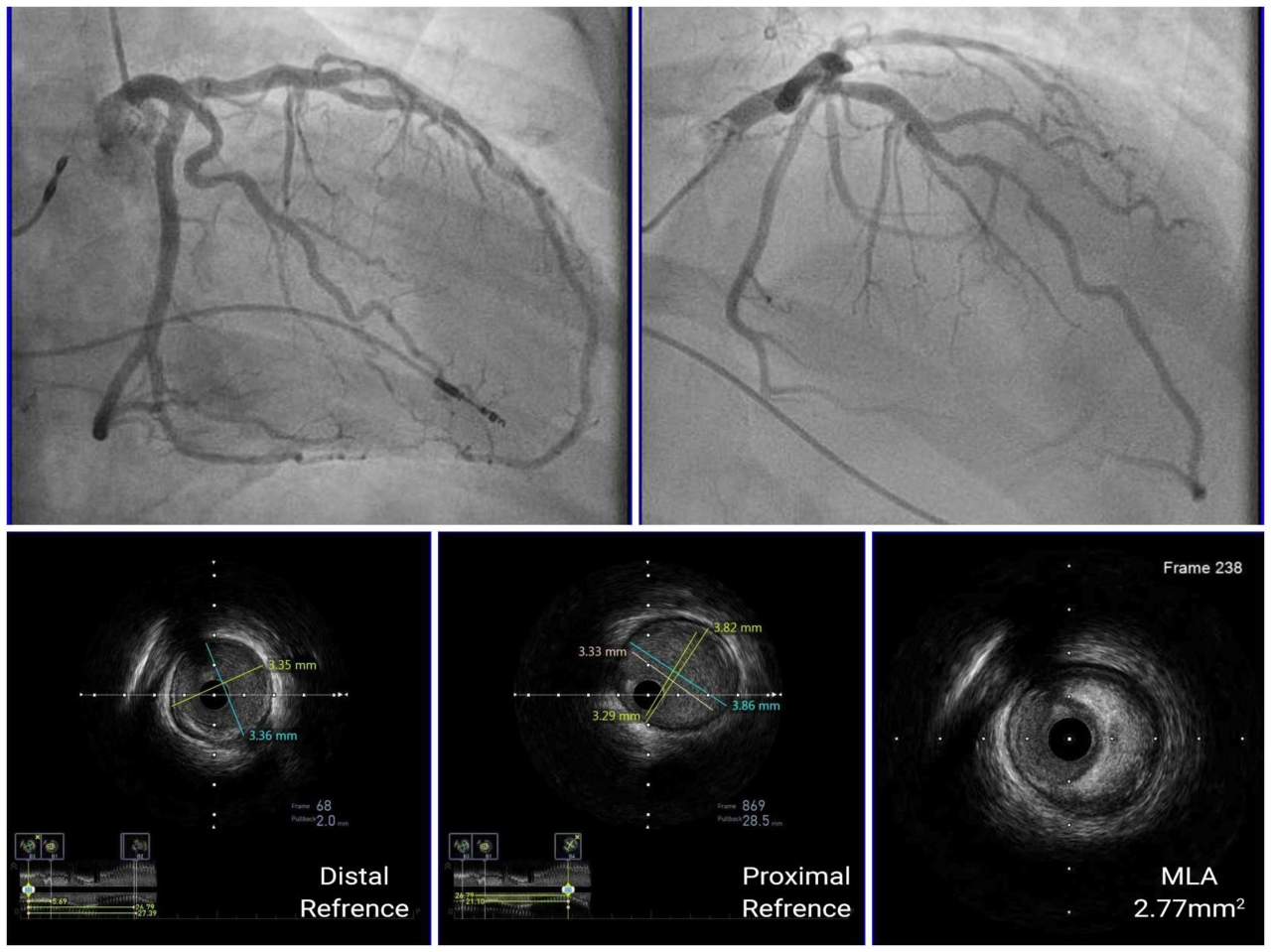 CASE 12: IVUS-guided LAD stent sizing - Cardiology Apps