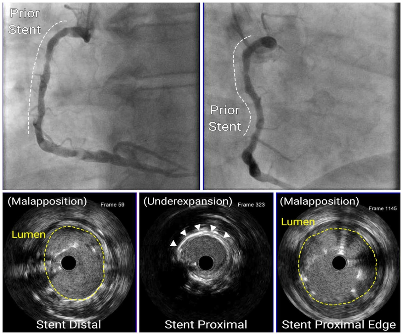 Case 16: Stent malapposition and underexpansion in RCA - Cardiology Apps