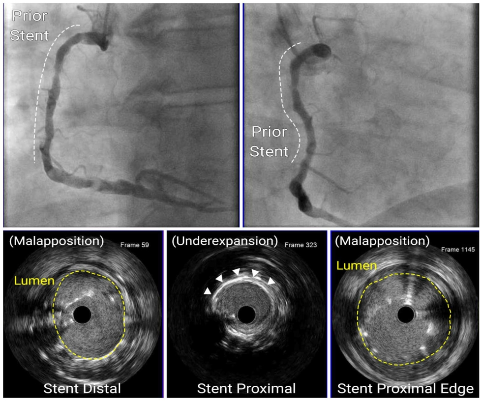 Case 16: Stent malapposition and underexpansion in RCA - Cardiology Apps