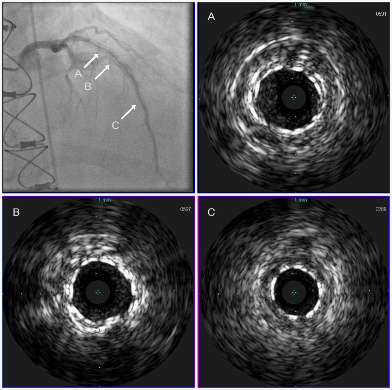 Case 18: In-stent restenosis treated with RA - Cardiology Apps