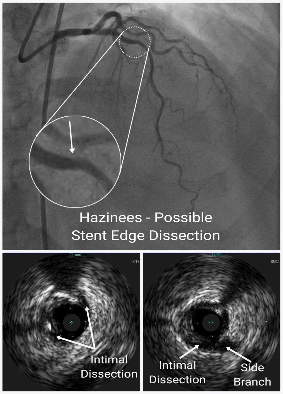 Case 19: Distal stent edge dissection after LAD bifurcation PCI ...