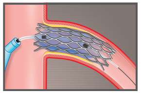 Ostial flash balloon - Cardiology Apps
