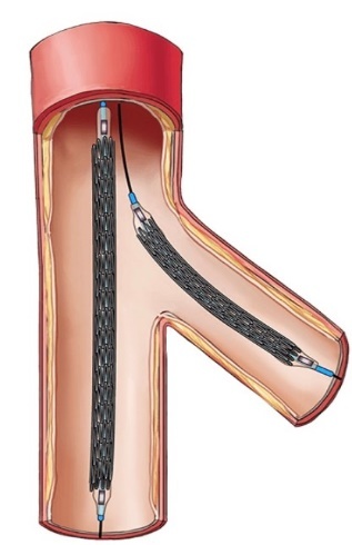 Mini-crush technique - Cardiology Apps