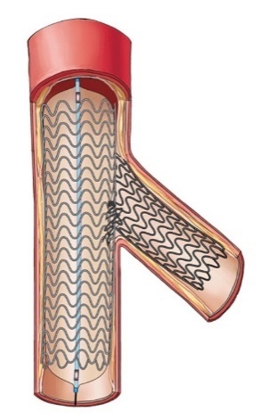 Mini-crush technique - Cardiology Apps