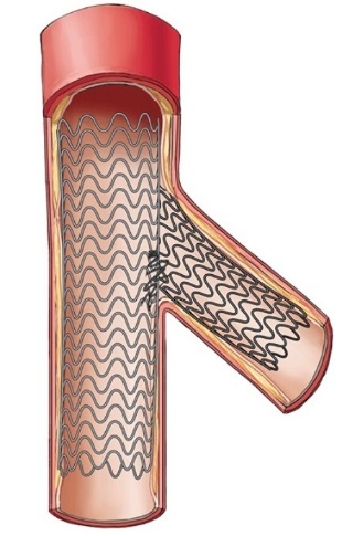 Mini-crush technique - Cardiology Apps