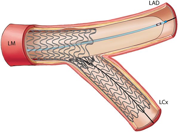 LMCA-Culotte technique - Cardiology Apps