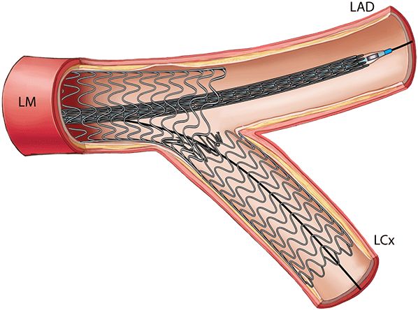LMCA-Culotte technique - Cardiology Apps
