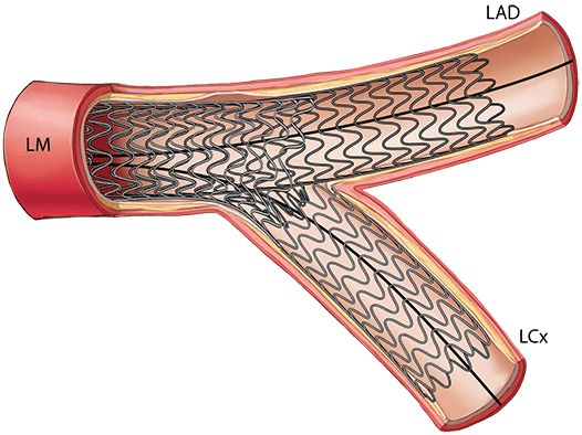 LMCA-Culotte technique - Cardiology Apps