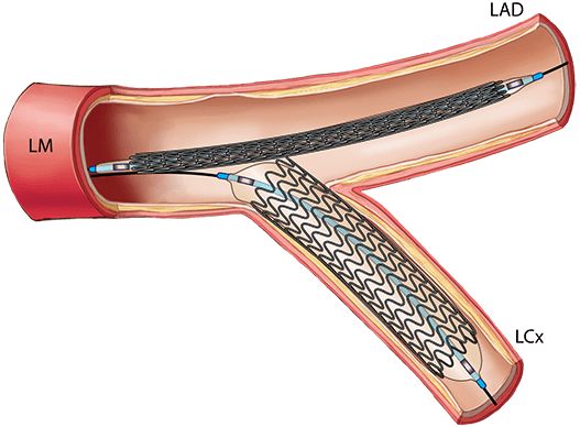 LMCA-mini-crush technique - Cardiology Apps