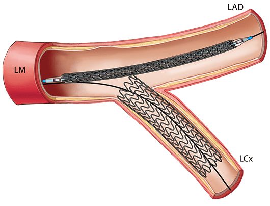 LMCA-mini-crush technique - Cardiology Apps