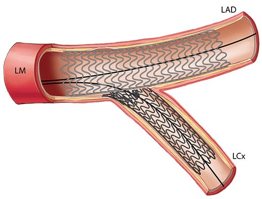 LMCA-mini-crush technique - Cardiology Apps