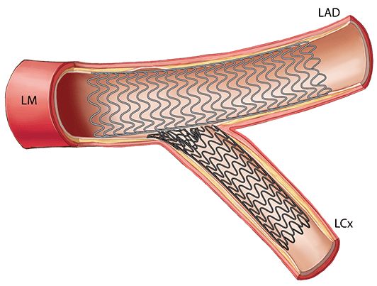 LMCA-mini-crush technique - Cardiology Apps