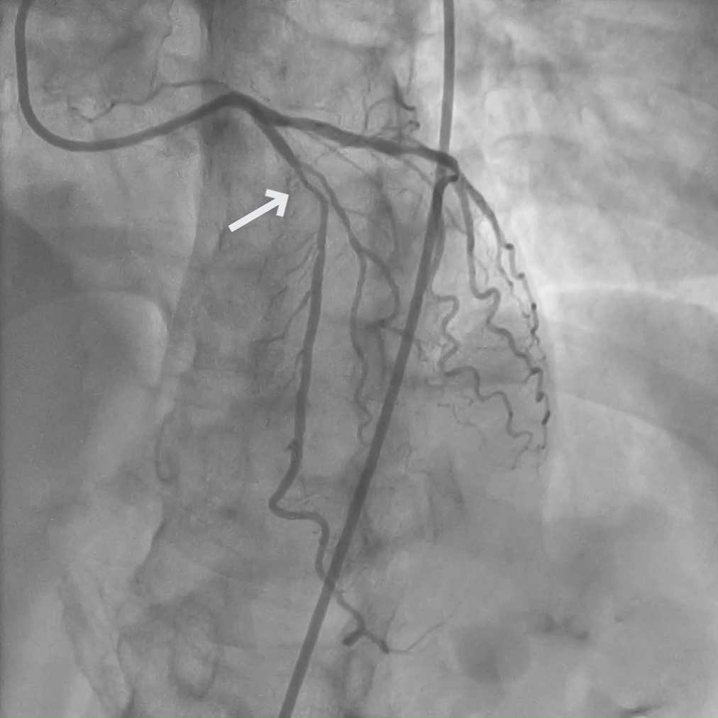 Case 7: LAD/D1 Bifurcation Lesion - Cardiology Apps