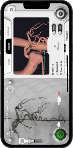 Ostial flash balloon - Cardiology Apps